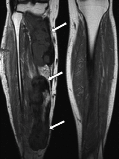 Key Desmoid Tumor Diagnostic Strategies - Springworks