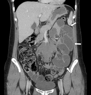 Key Desmoid Tumor Diagnostic Strategies - Springworks