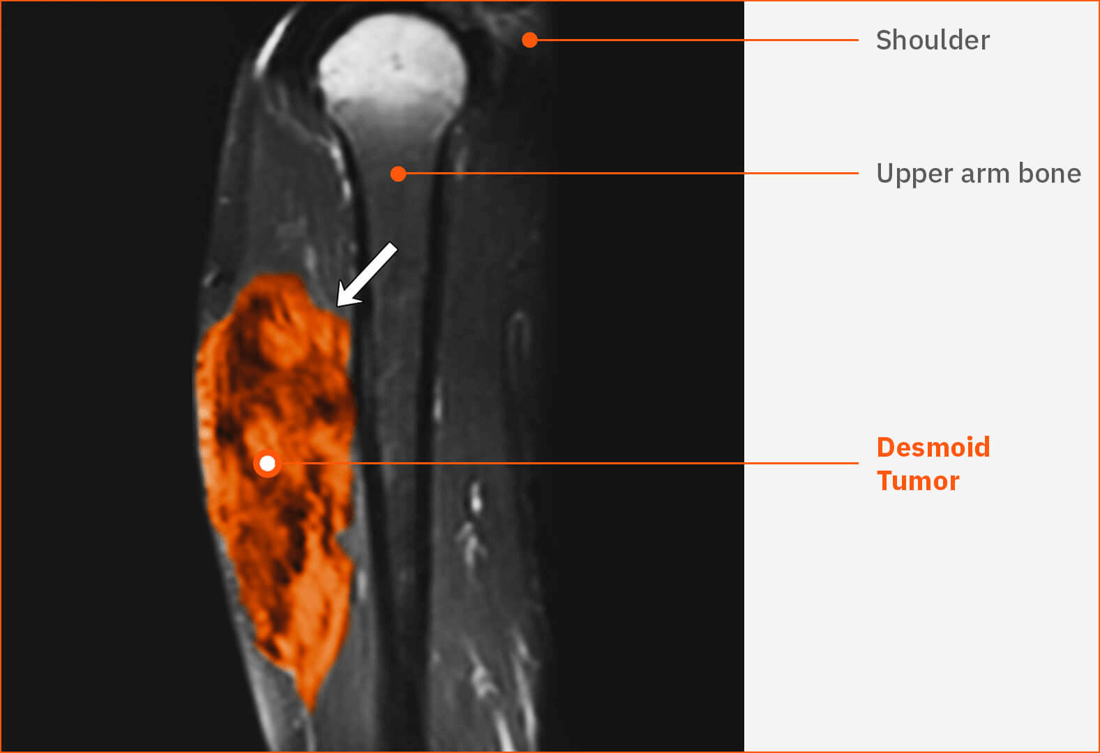What is a desmoid tumor? - Springworks